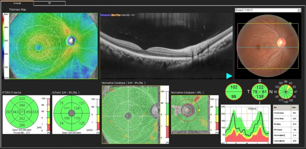 NIDEK launches Retina Scan Duo™2 OCT / Fundus Camera ｜ NIDEK