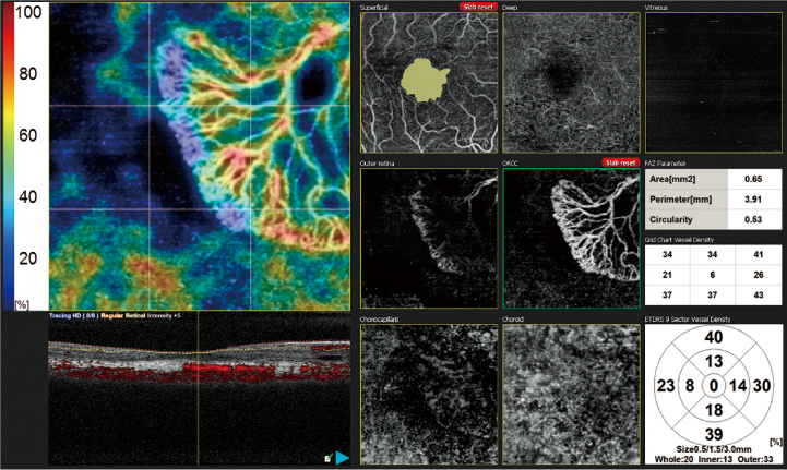 OCT-Angiography option for the Mirante SLO/OCT and Retina Scan Duo™ 2 ...