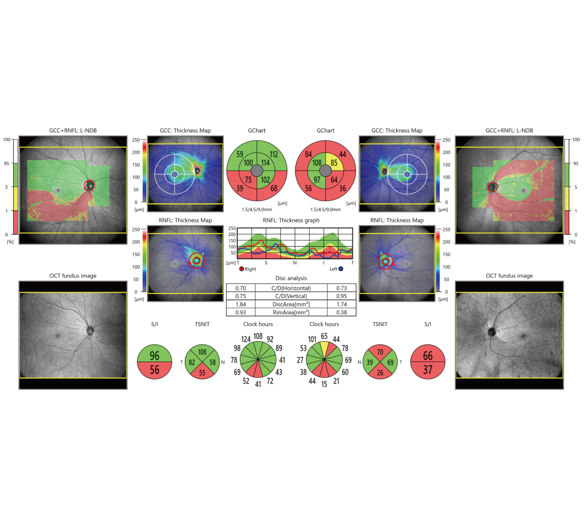 Software for NIDEK OCT series Long Axial Length Normative Database ｜ NIDEK