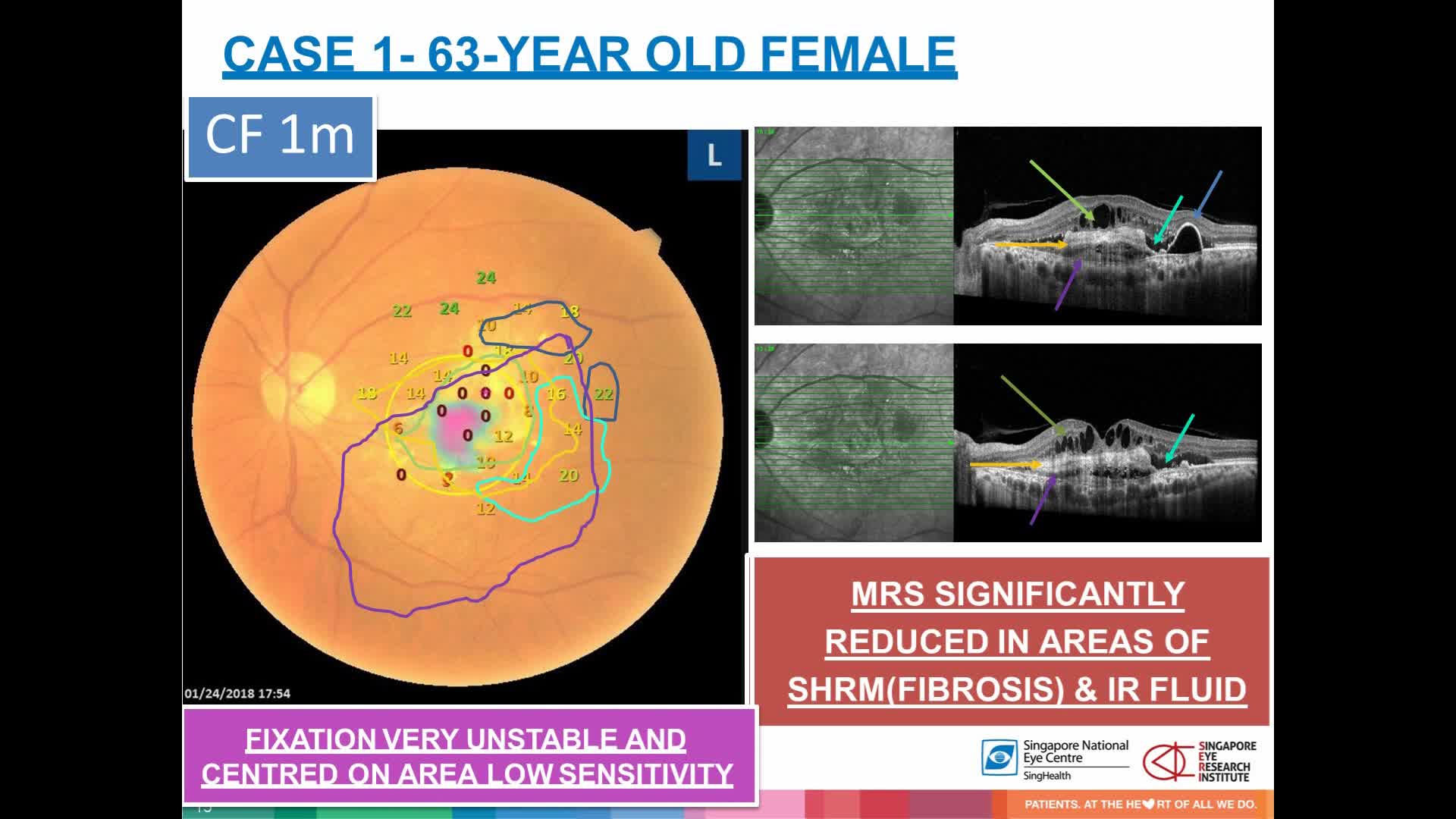 Microperimeter MP-3 ｜ NIDEK
