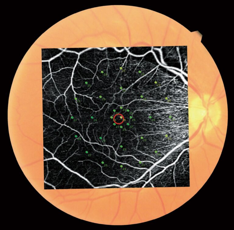 Microperimeter MP-3 ｜ NIDEK
