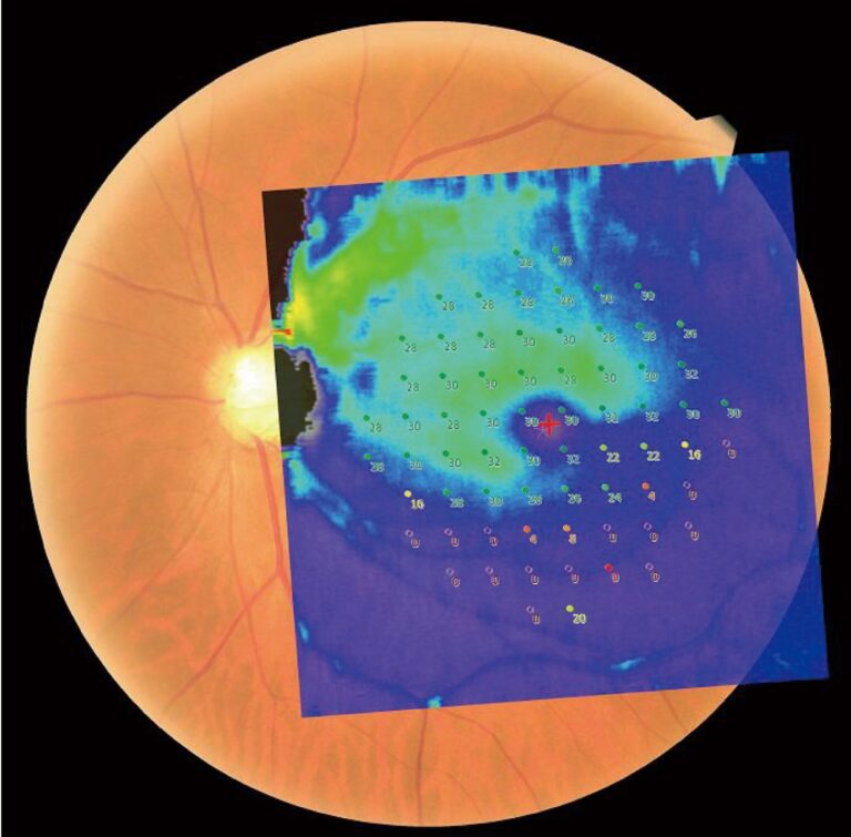 Microperimeter MP-3 ｜ NIDEK
