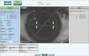 Optical Biometer AL-Scan ｜ NIDEK